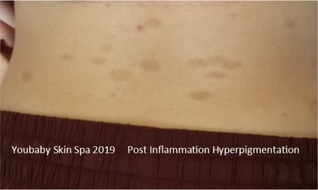 How to Remove Brown Spots